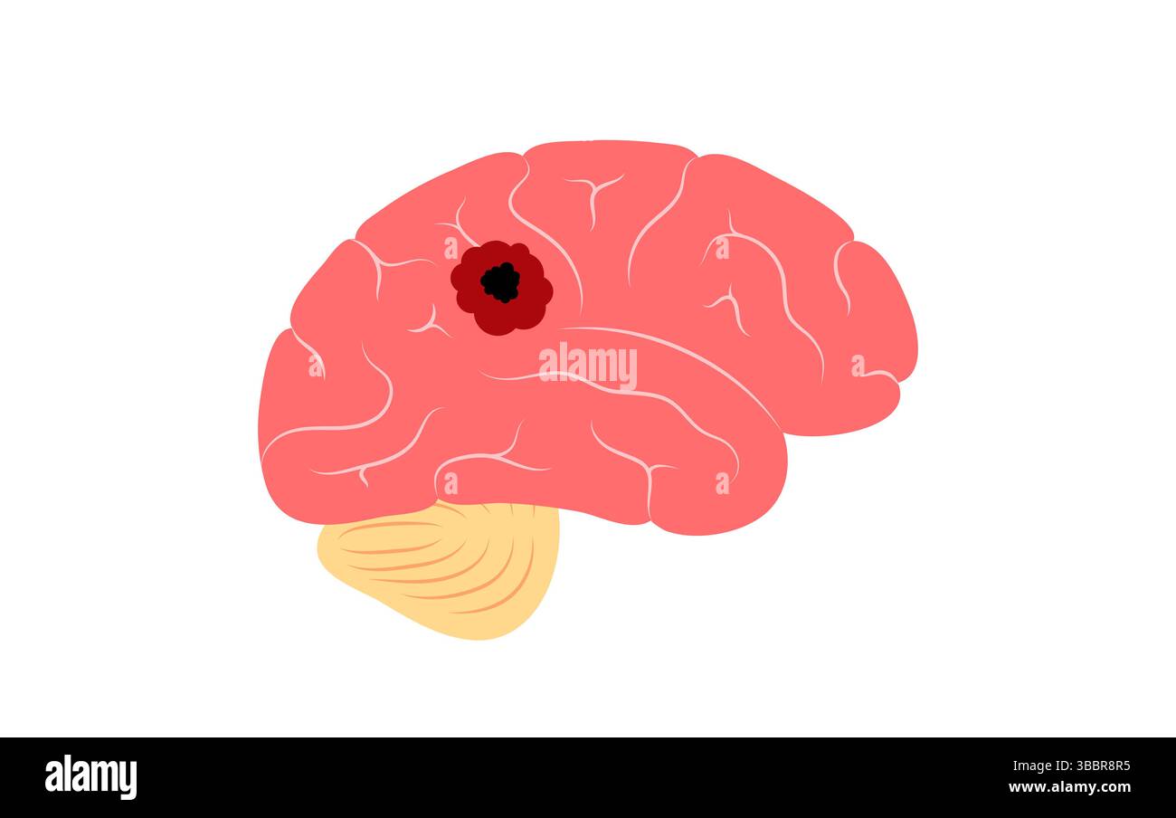 Illustration of brain cancer. A cancerous growth that develops in the ...