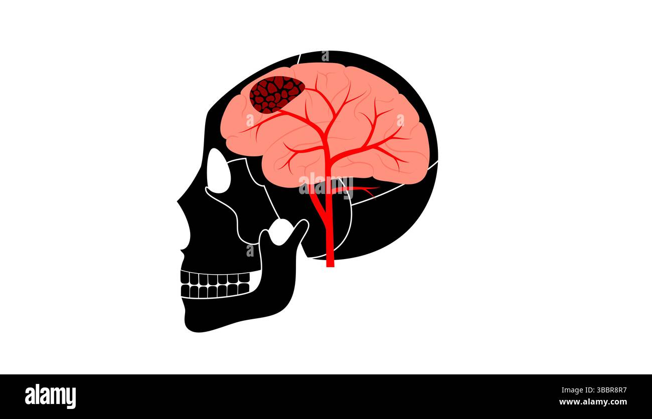 Illustration of brain cancer. A cancerous growth that develops in the ...
