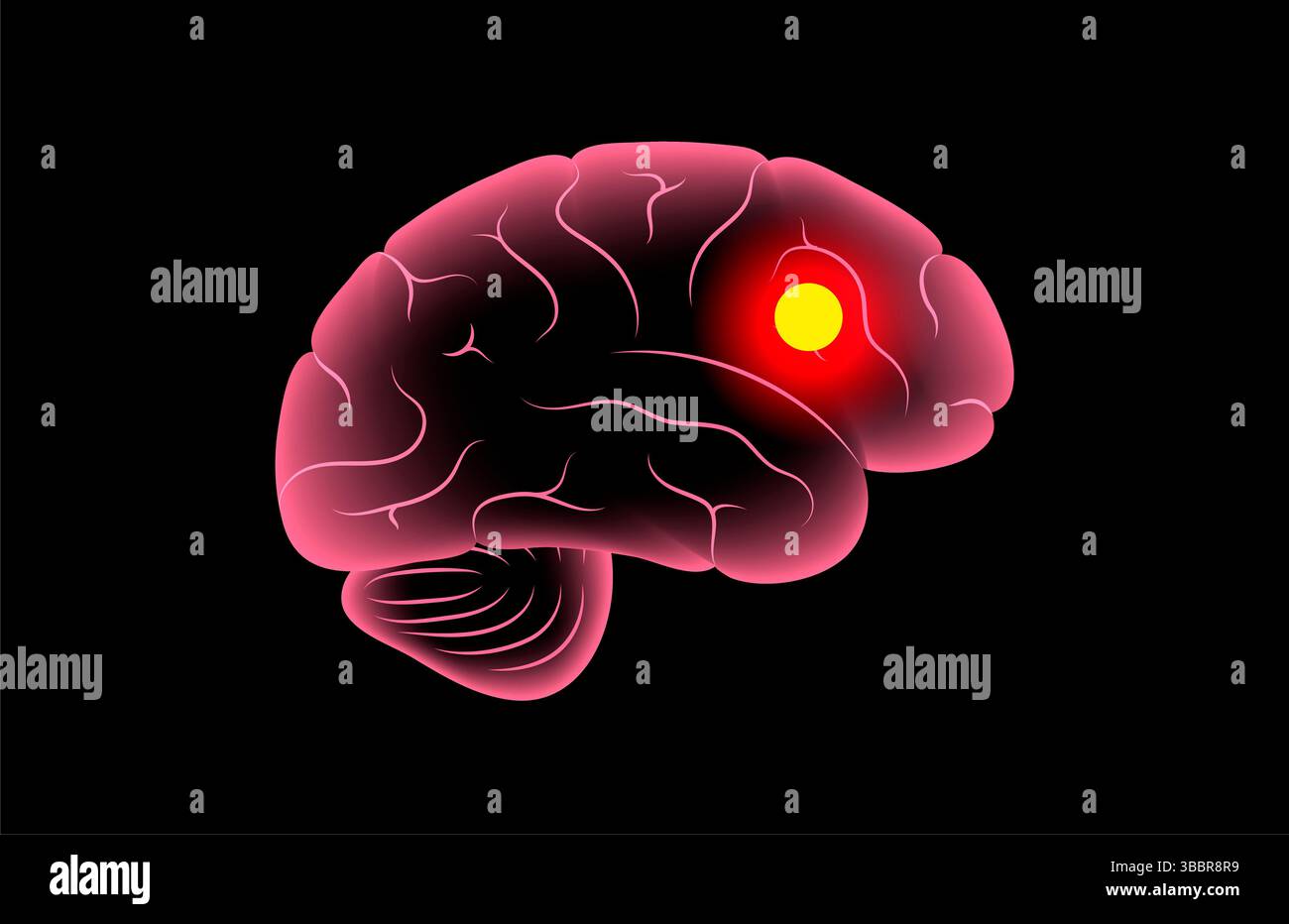 Illustration of brain cancer. A cancerous growth that develops in the ...