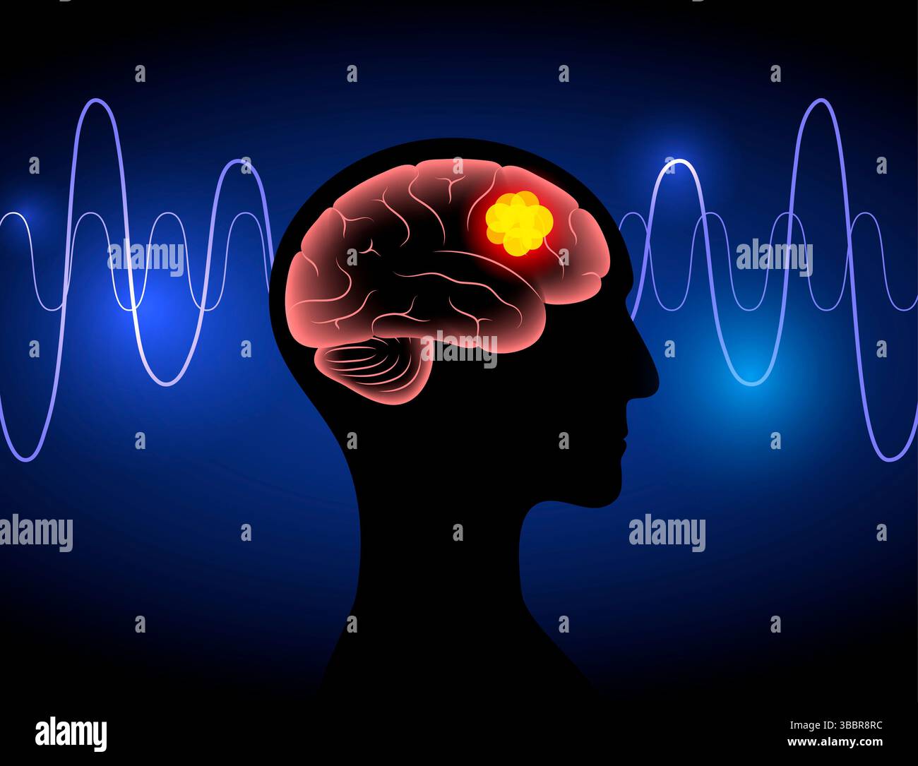 Illustration of brain cancer. A cancerous growth that develops in the ...