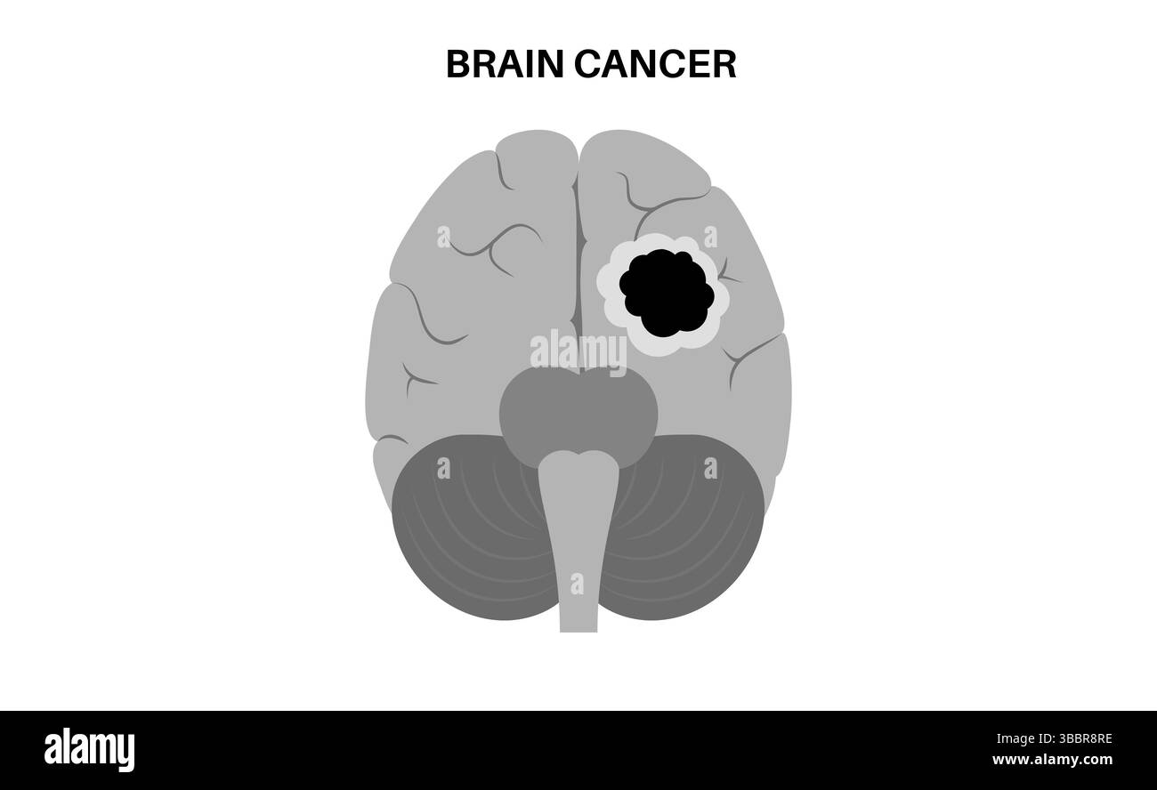 Illustration of brain cancer. A cancerous growth that develops in the ...