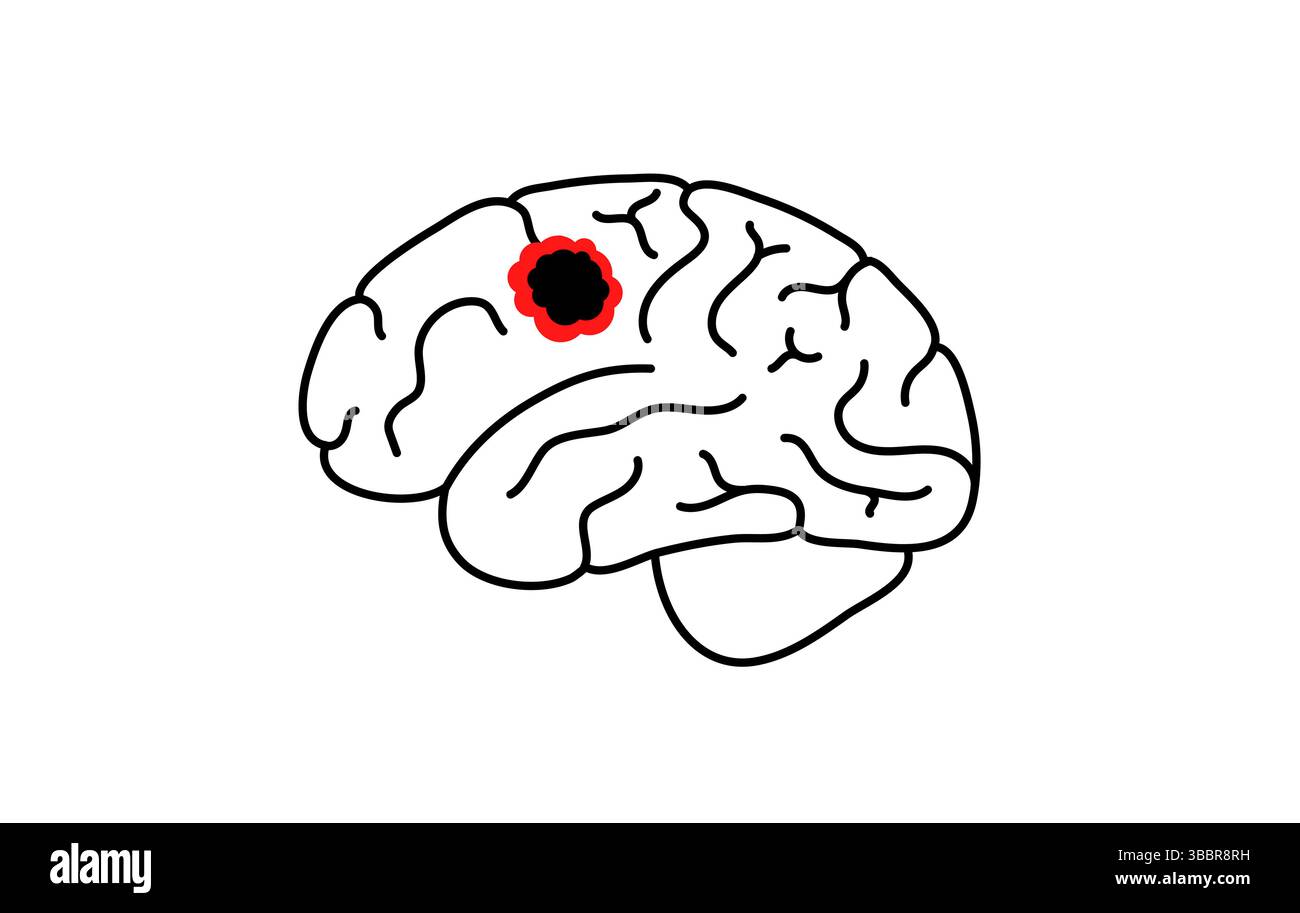 Illustration of brain cancer. A cancerous growth that develops in the ...