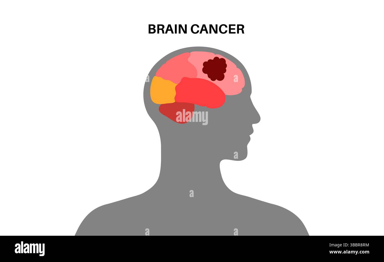 Illustration of brain cancer. A cancerous growth that develops in the ...