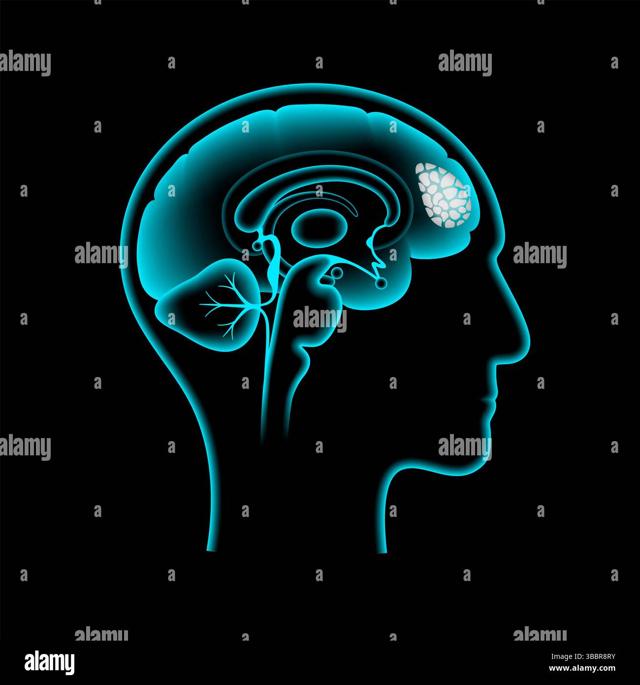 Illustration of brain cancer. A cancerous growth that develops in the ...