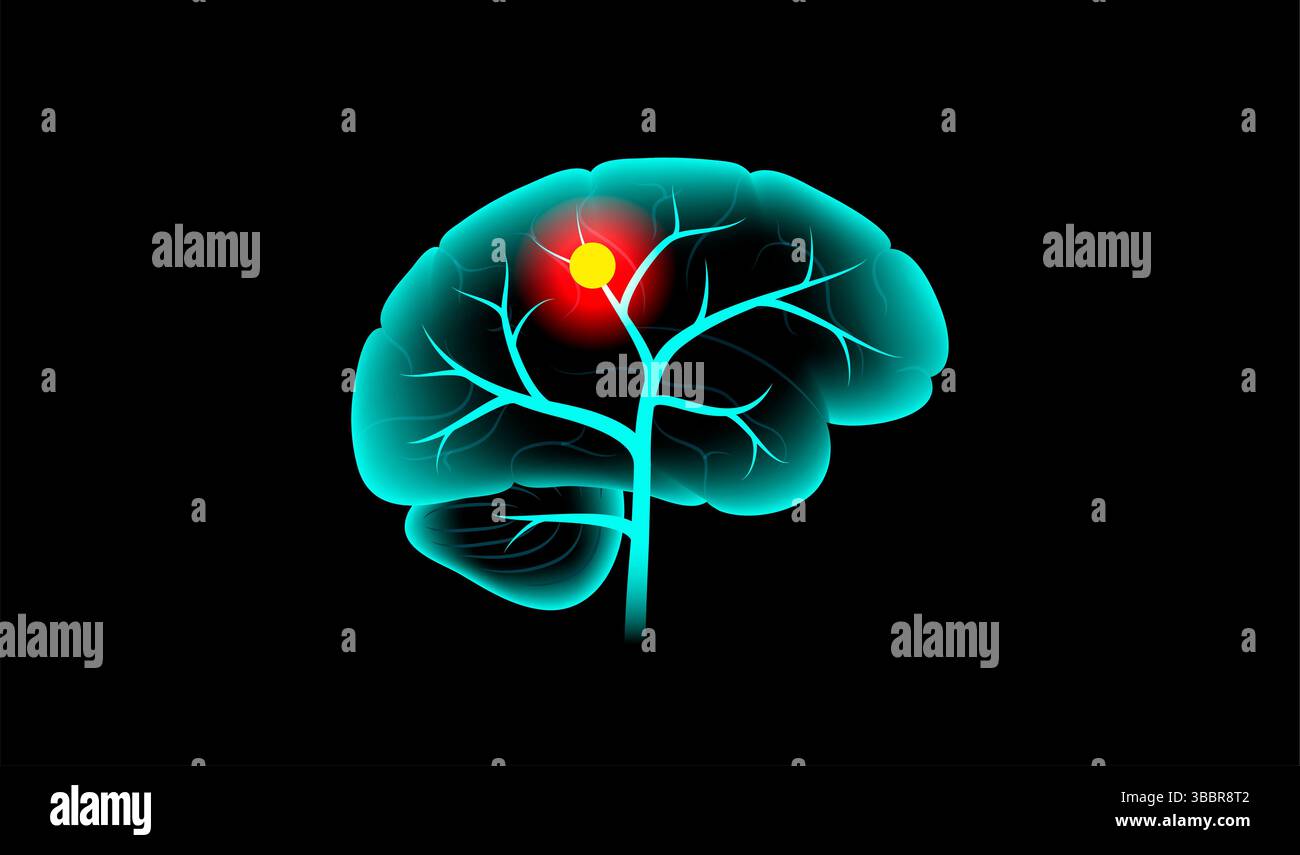Illustration of brain cancer. A cancerous growth that develops in the ...