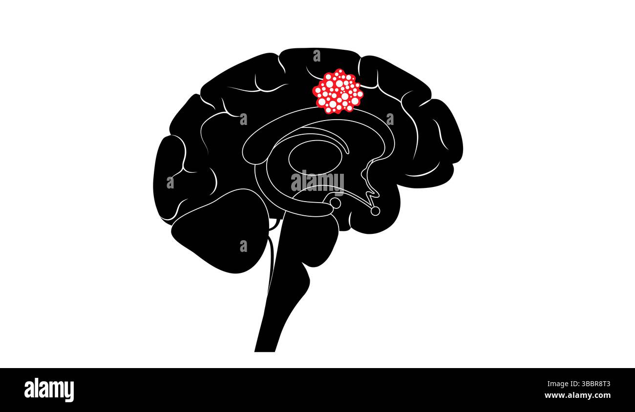 Illustration of brain cancer. A cancerous growth that develops in the ...