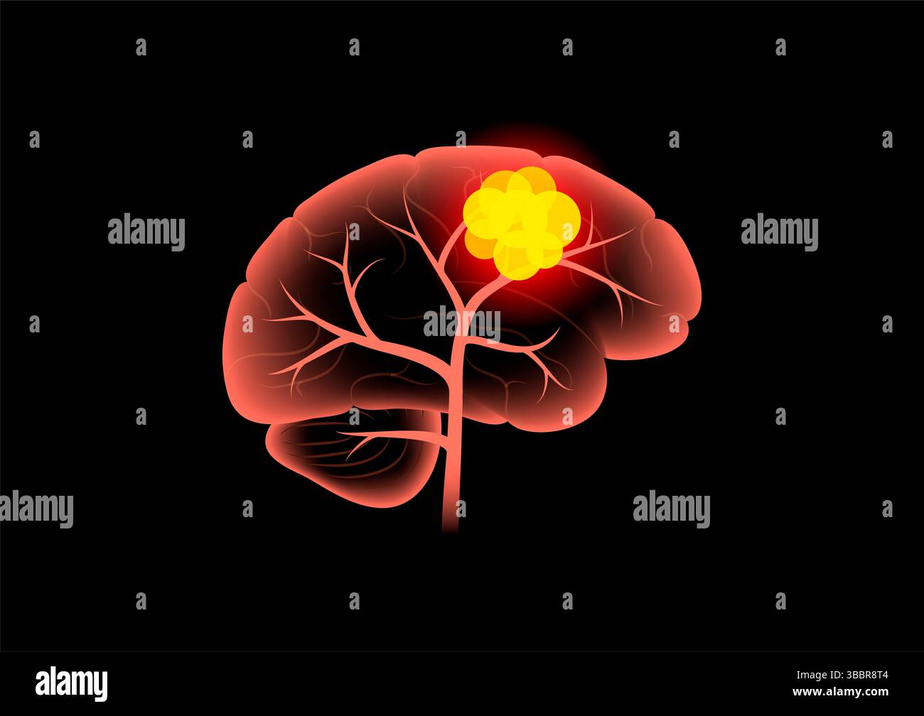 Illustration of brain cancer. A cancerous growth that develops in the ...