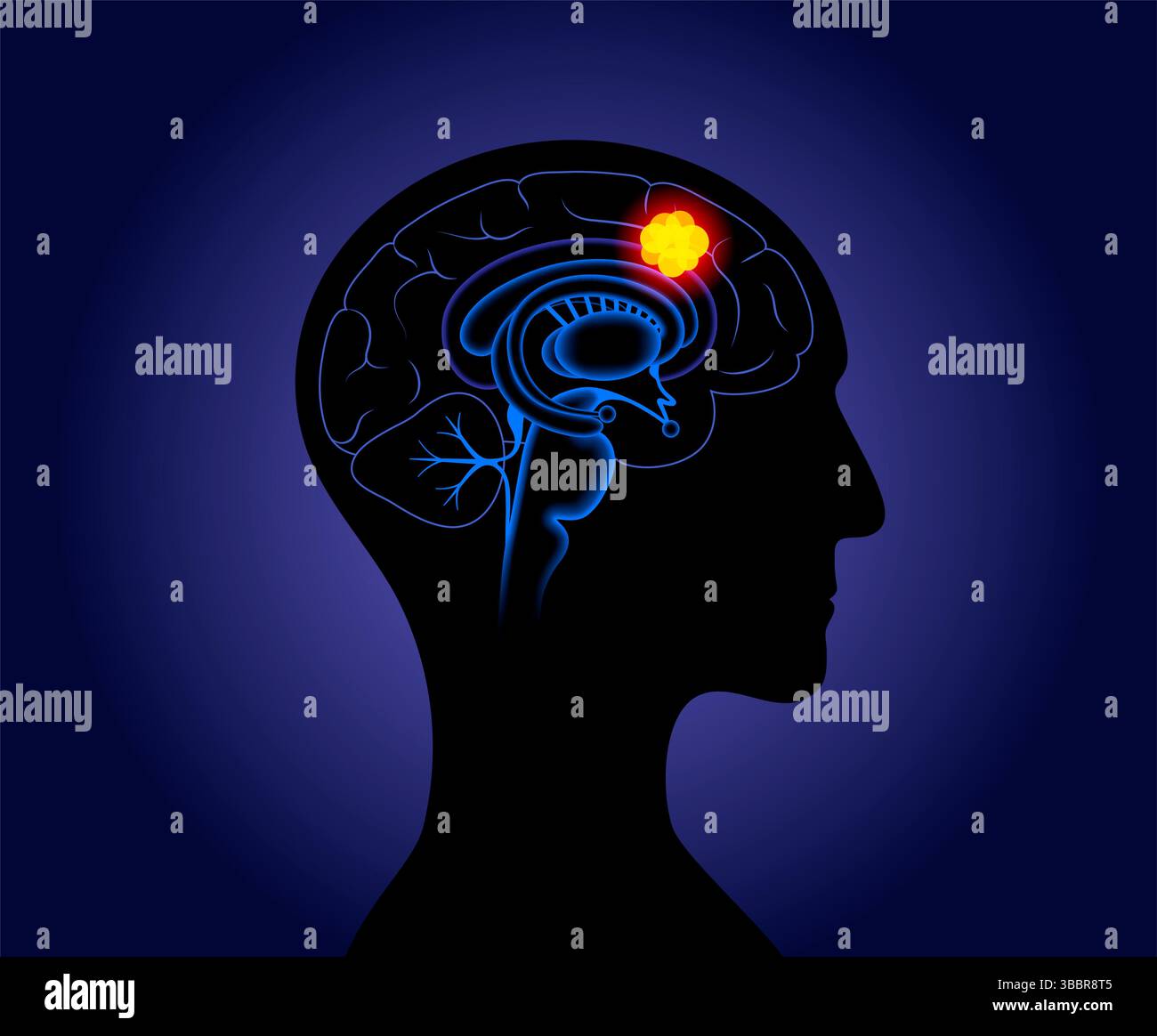 Illustration of brain cancer. A cancerous growth that develops in the ...