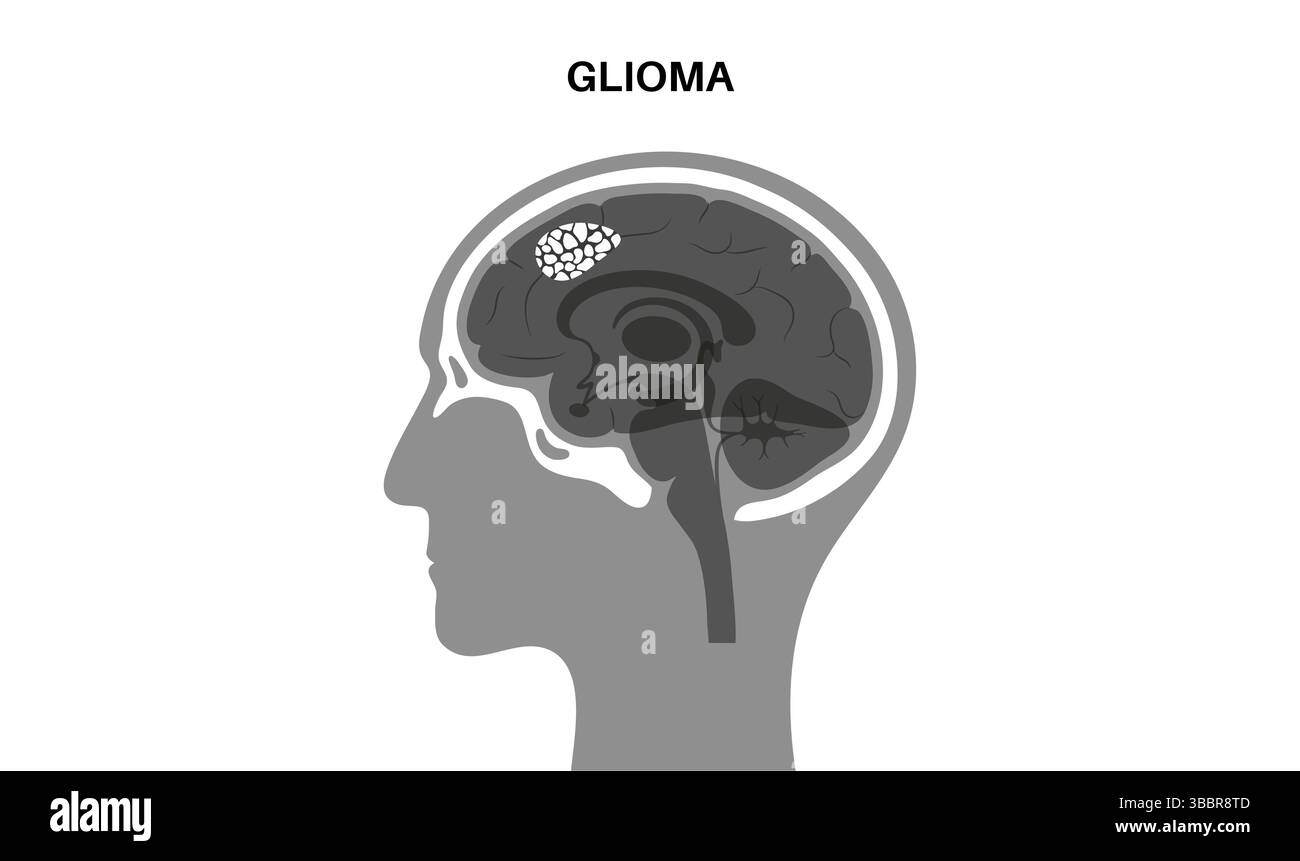 Illustration of a glioma, a cancerous brain tumour that originates from ...