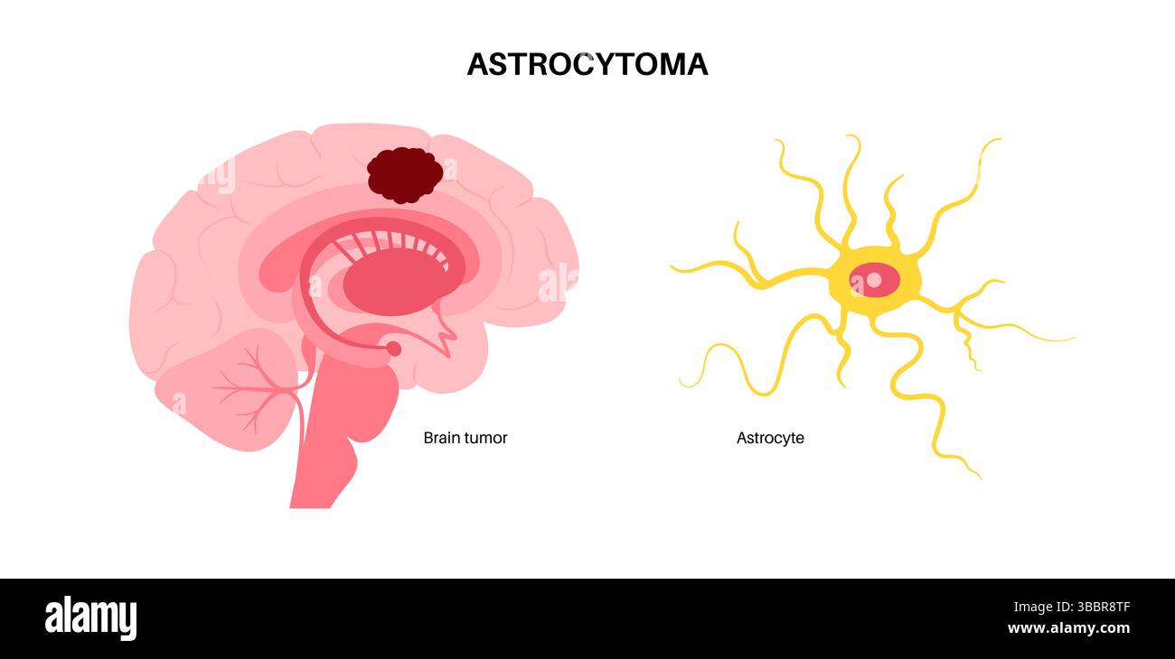 Illustration of an astrocytoma. This is a type of brain tumour that ...