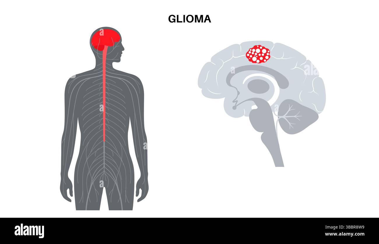 Illustration of a glioma, a cancerous brain tumour that originates from ...