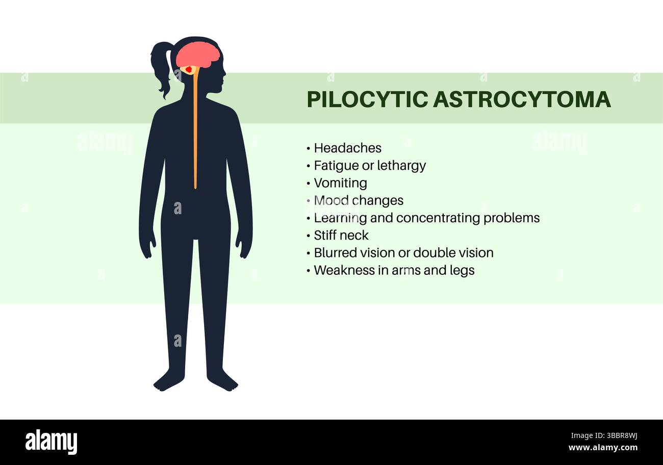 Illustration of a pilocytic astrocytoma. This is a type of brain tumour ...