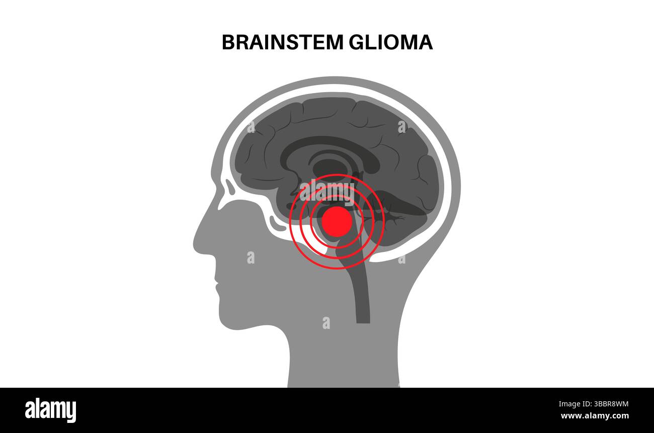 Illustration of a brainstem glioma. This is a tumour that develops in ...