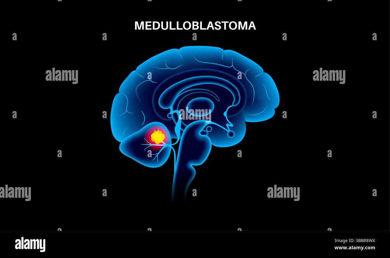 Illustration of a medulloblastoma. This is a malignant, invasive brain ...