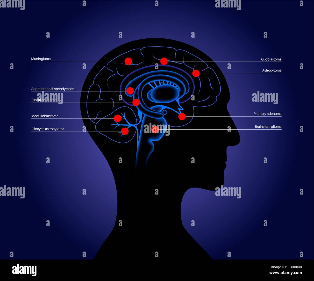 Illustration of primary brain tumours, showing a meningioma ...