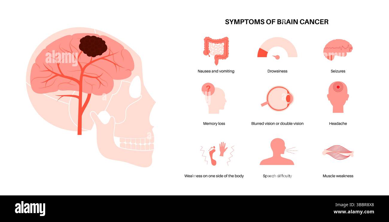 Illustration of primary brain tumour symptoms. These include headaches ...