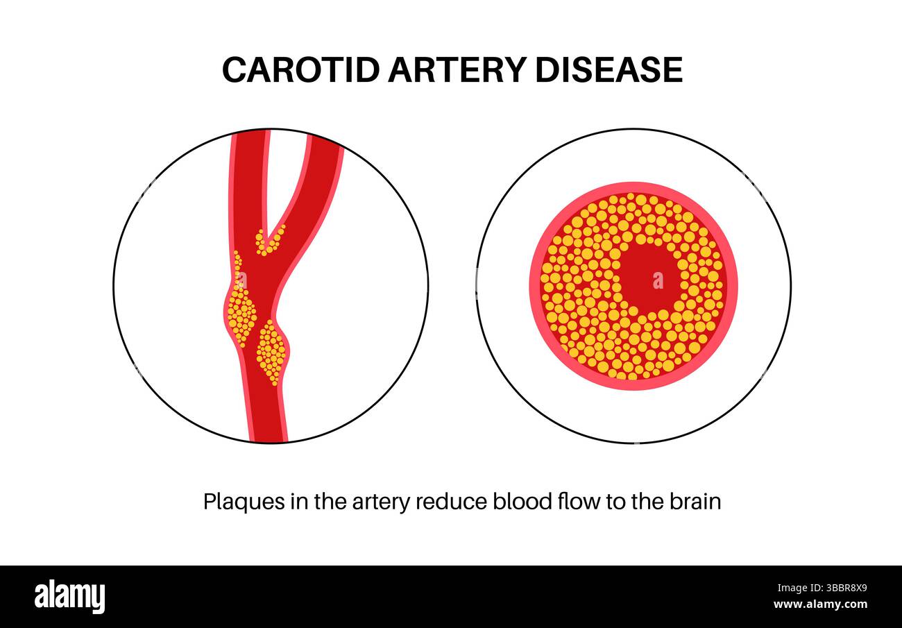 Illustration of carotid artery disease. This occurs when fatty deposits ...