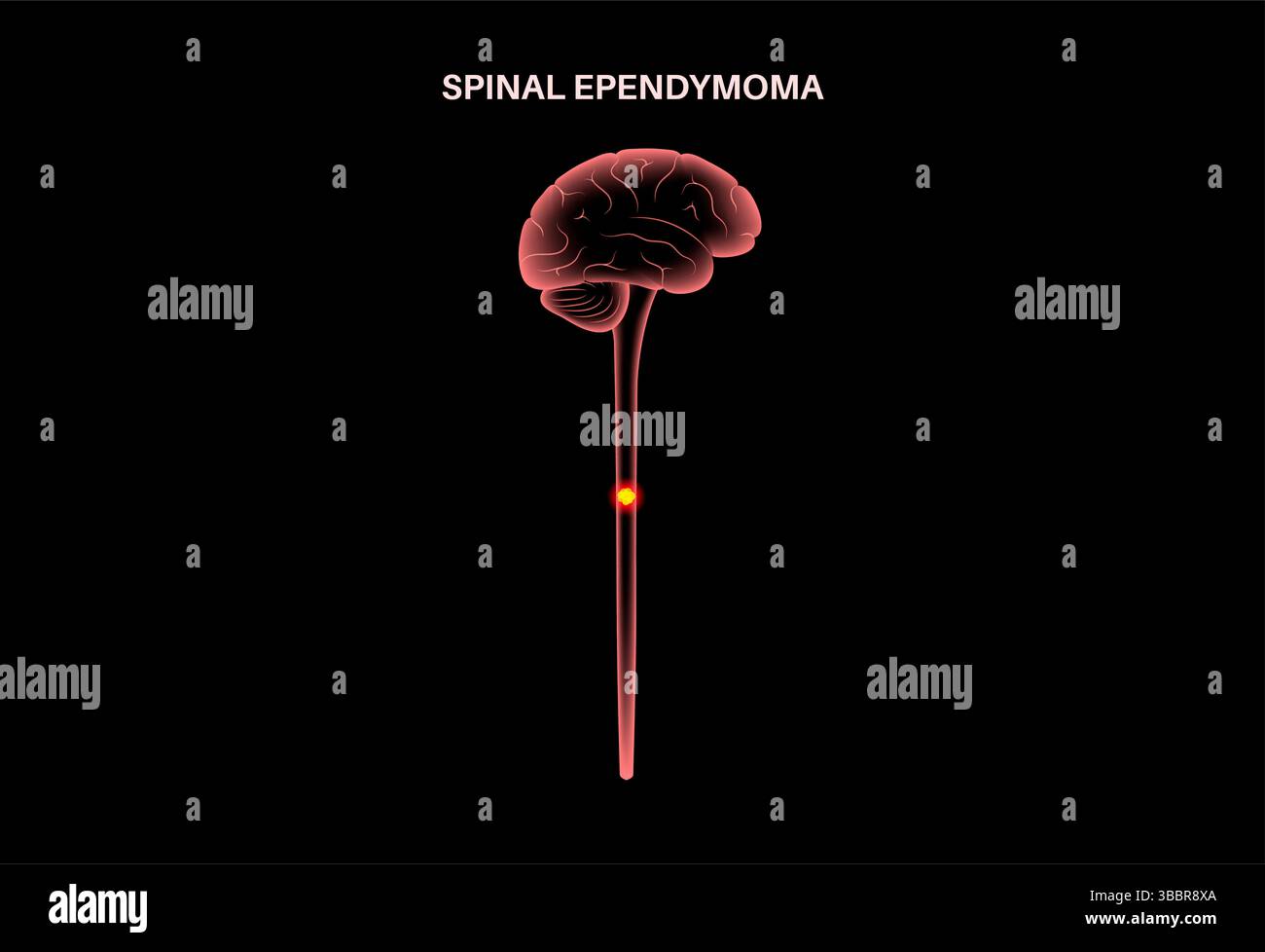 Neuro oncological hi-res stock photography and images - Alamy
