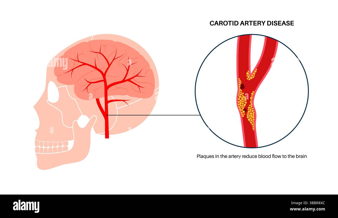 Illustration of carotid artery disease. This occurs when fatty deposits ...