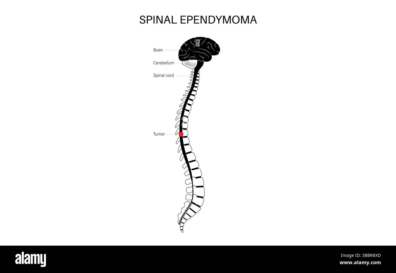 Illustration of a spinal ependymoma. This is a tumour that grows within the spinal cord. It ...
