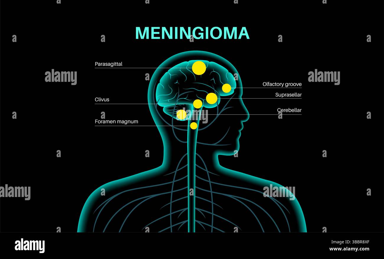 Illustration of a meningioma. This is a tumour that grows from the ...