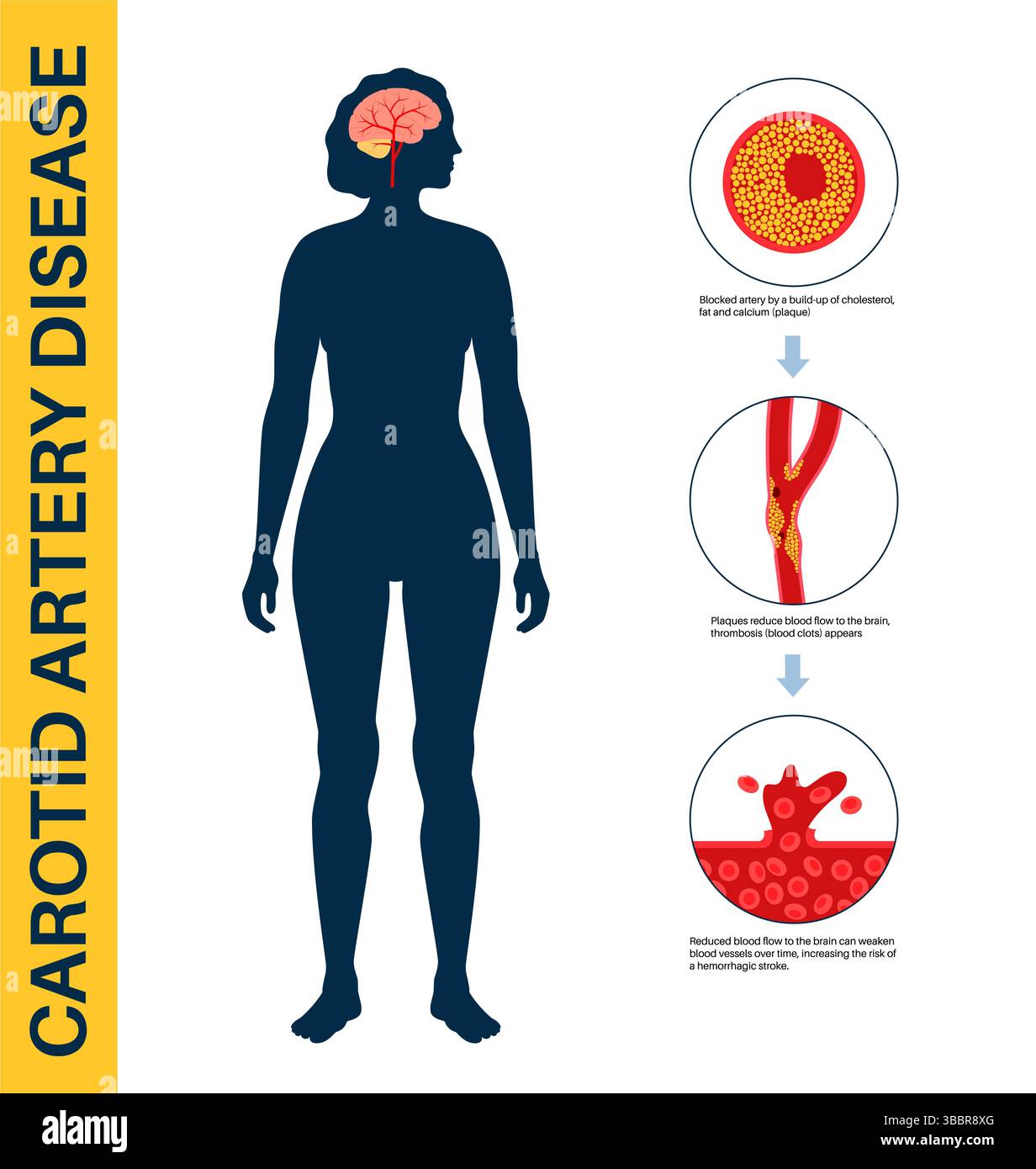 Illustration of carotid artery disease. This occurs when fatty deposits ...