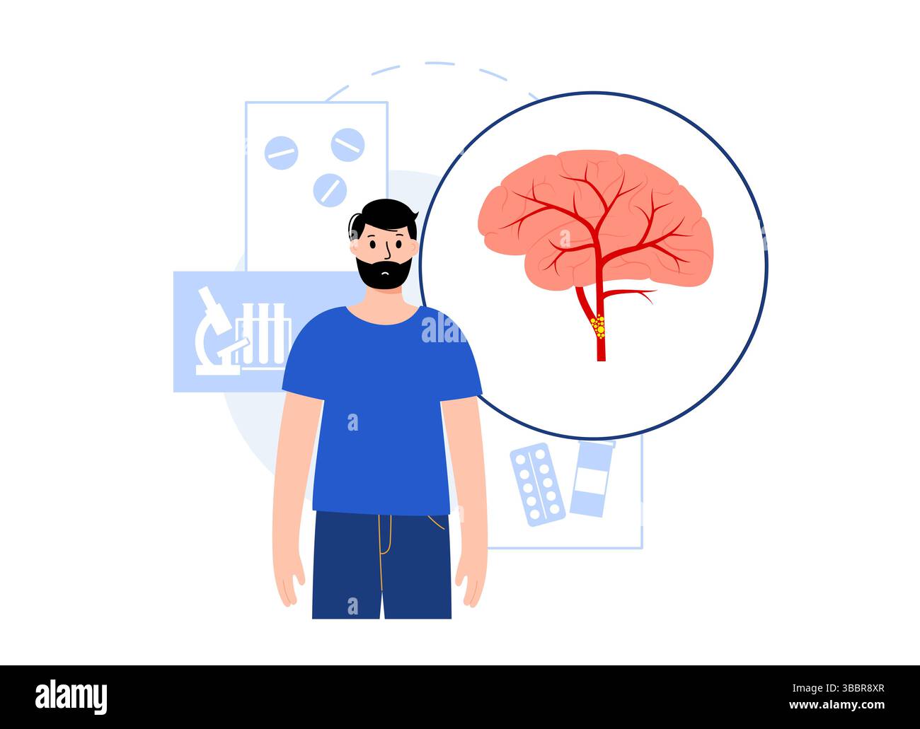 Illustration of carotid artery disease. This occurs when fatty deposits ...