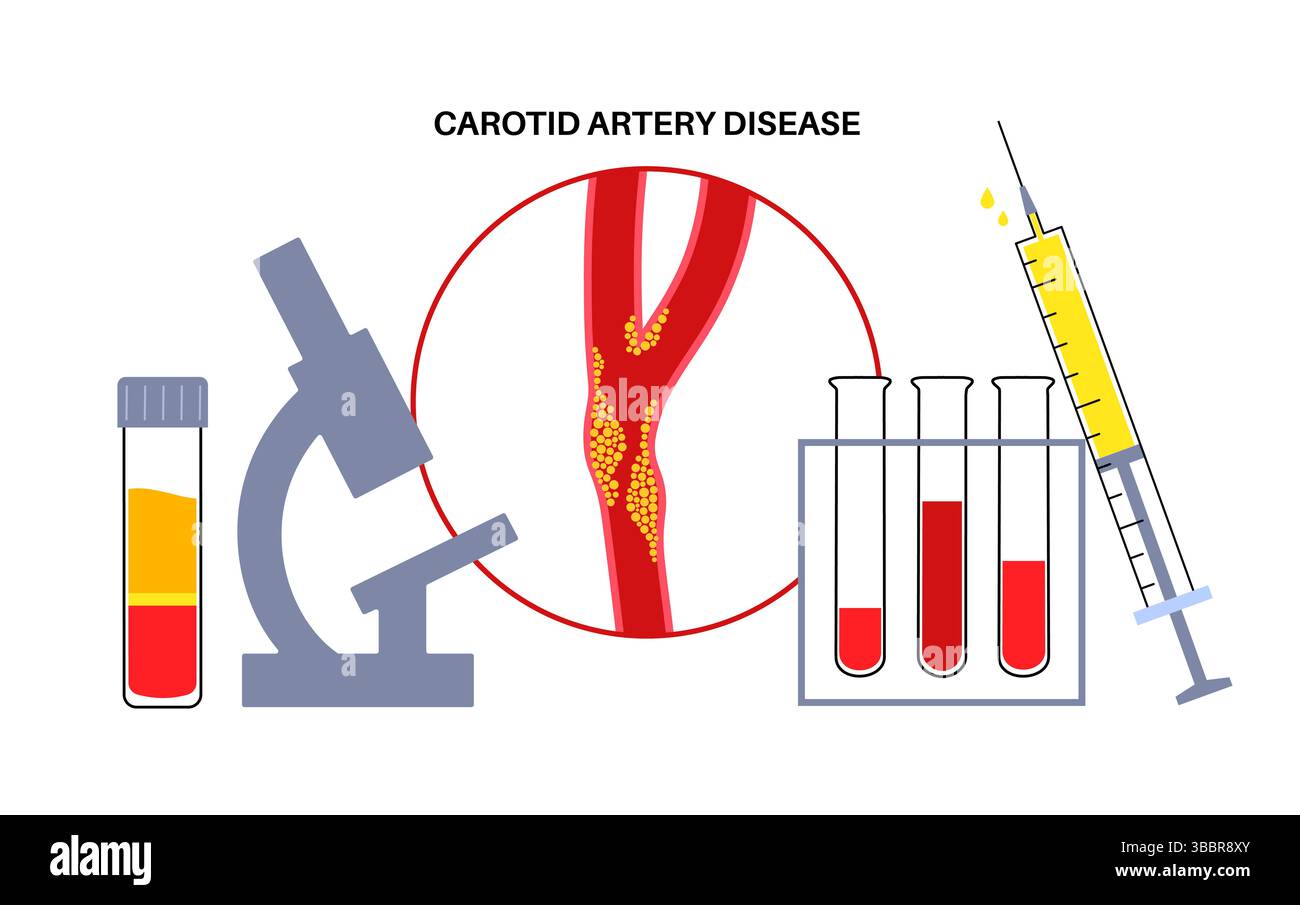 Illustration of carotid artery disease. This occurs when fatty deposits ...