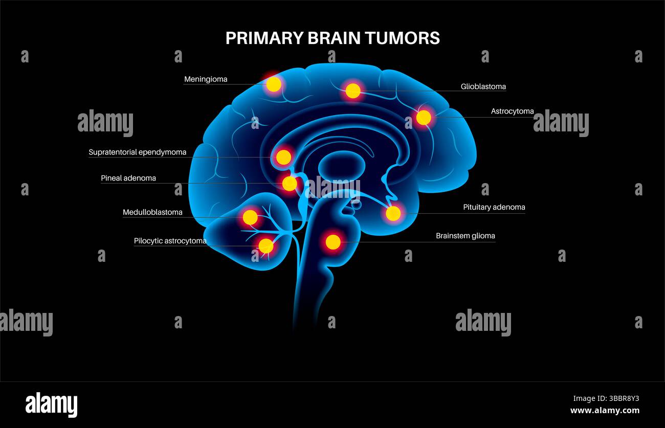 Illustration of primary brain tumours, showing a meningioma ...