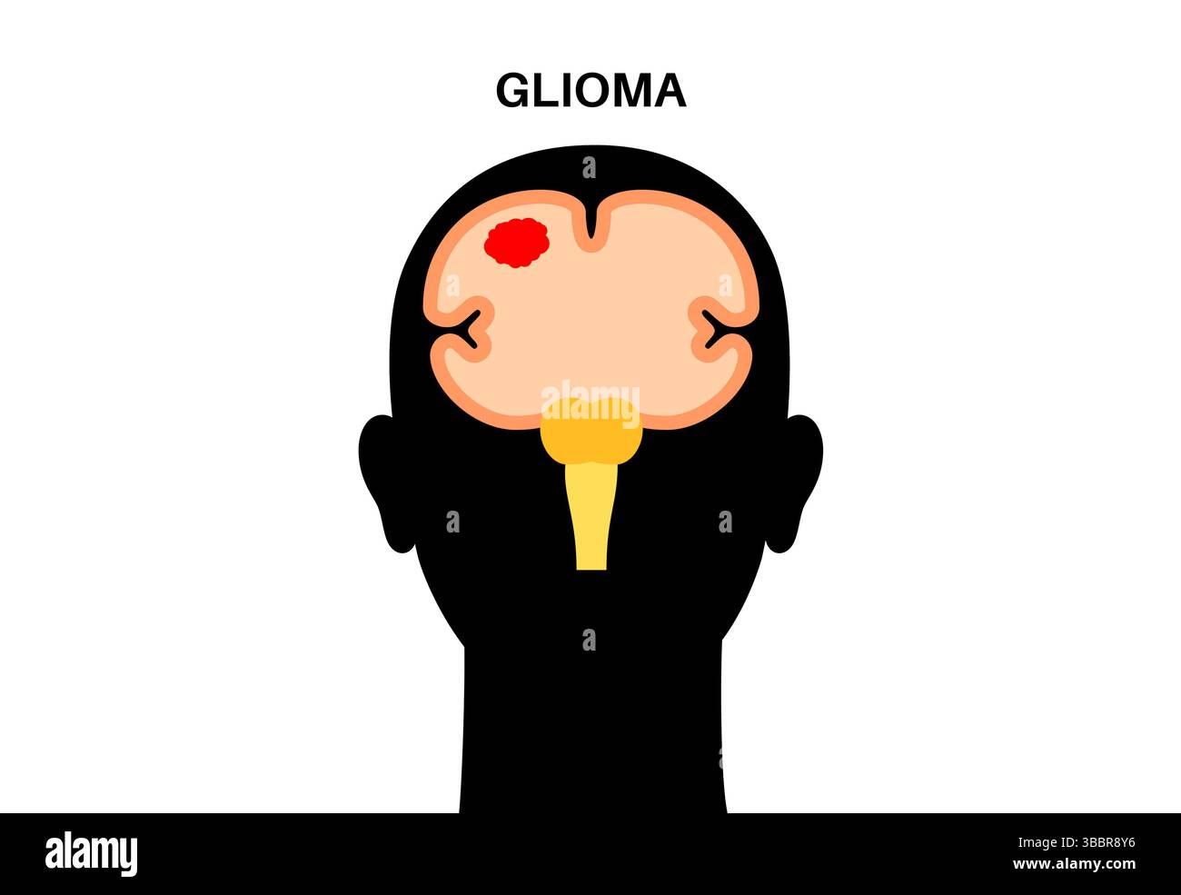 Illustration of a glioma, a cancerous brain tumour that originates from ...