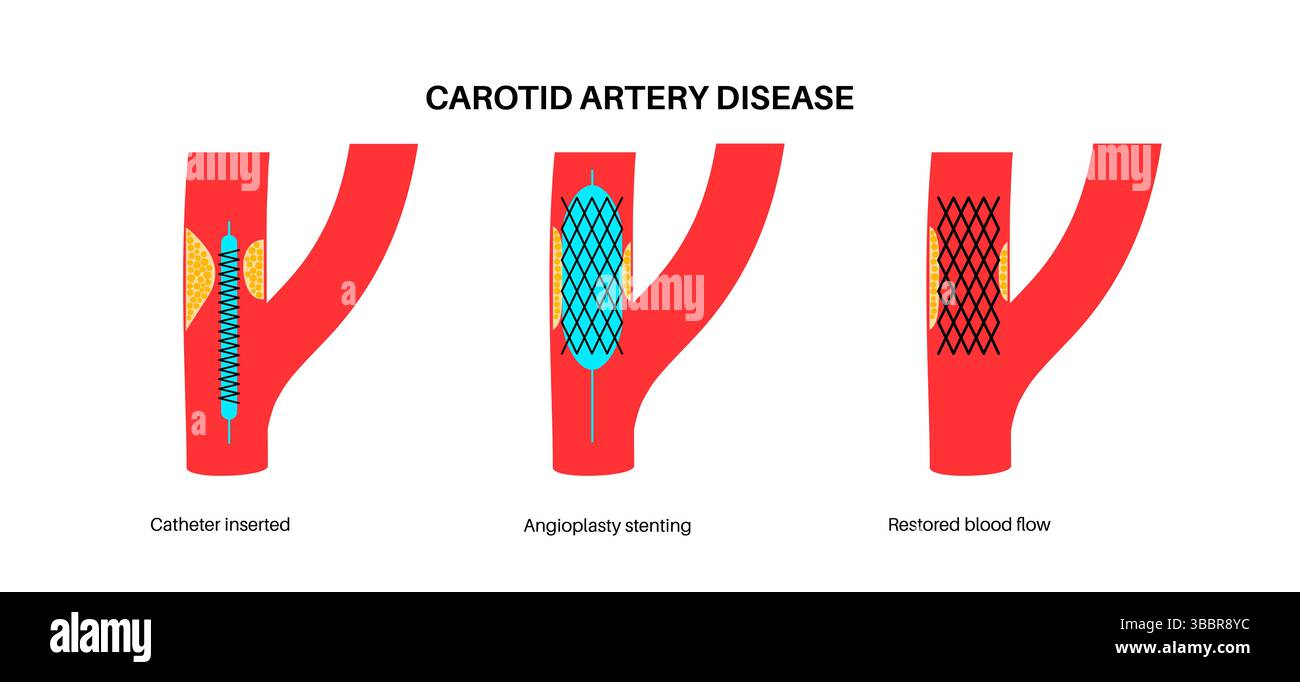 Carotid artery stent hi-res stock photography and images - Alamy