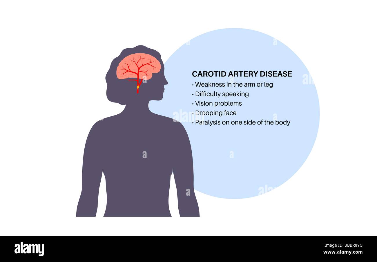 Illustration of carotid artery disease. This occurs when fatty deposits ...