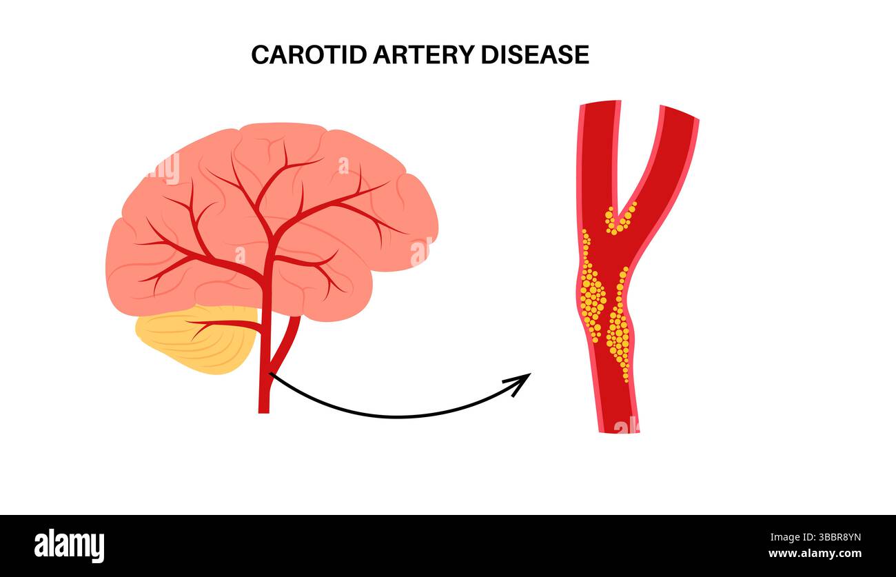 Illustration of carotid artery disease. This occurs when fatty deposits ...