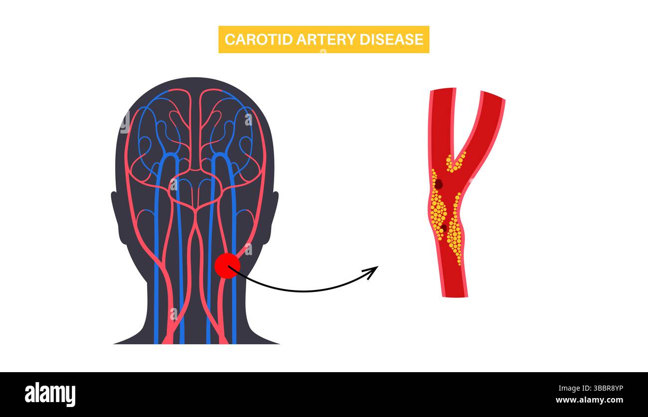 Illustration of carotid artery disease. This occurs when fatty deposits ...