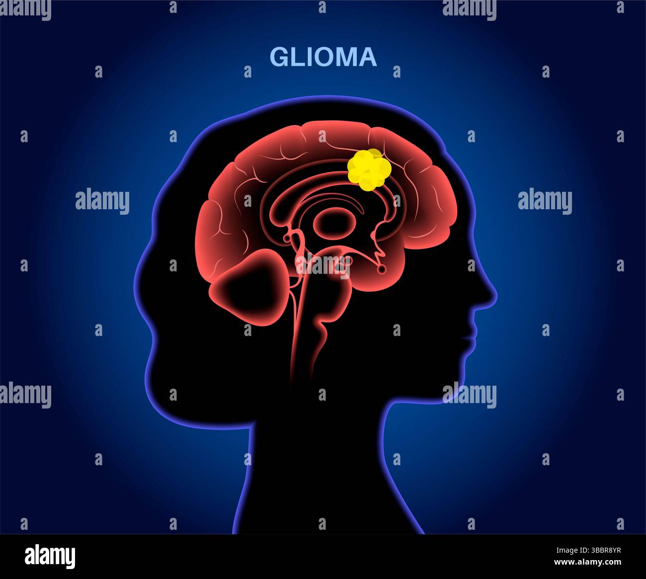 Illustration of a glioma, a cancerous brain tumour that originates from ...