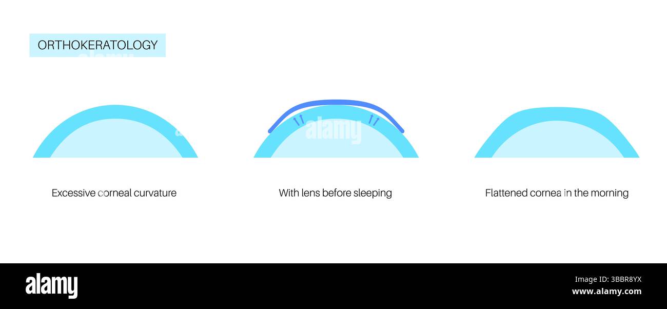 Illustration of orthokeratology fitted lens. These are specially ...