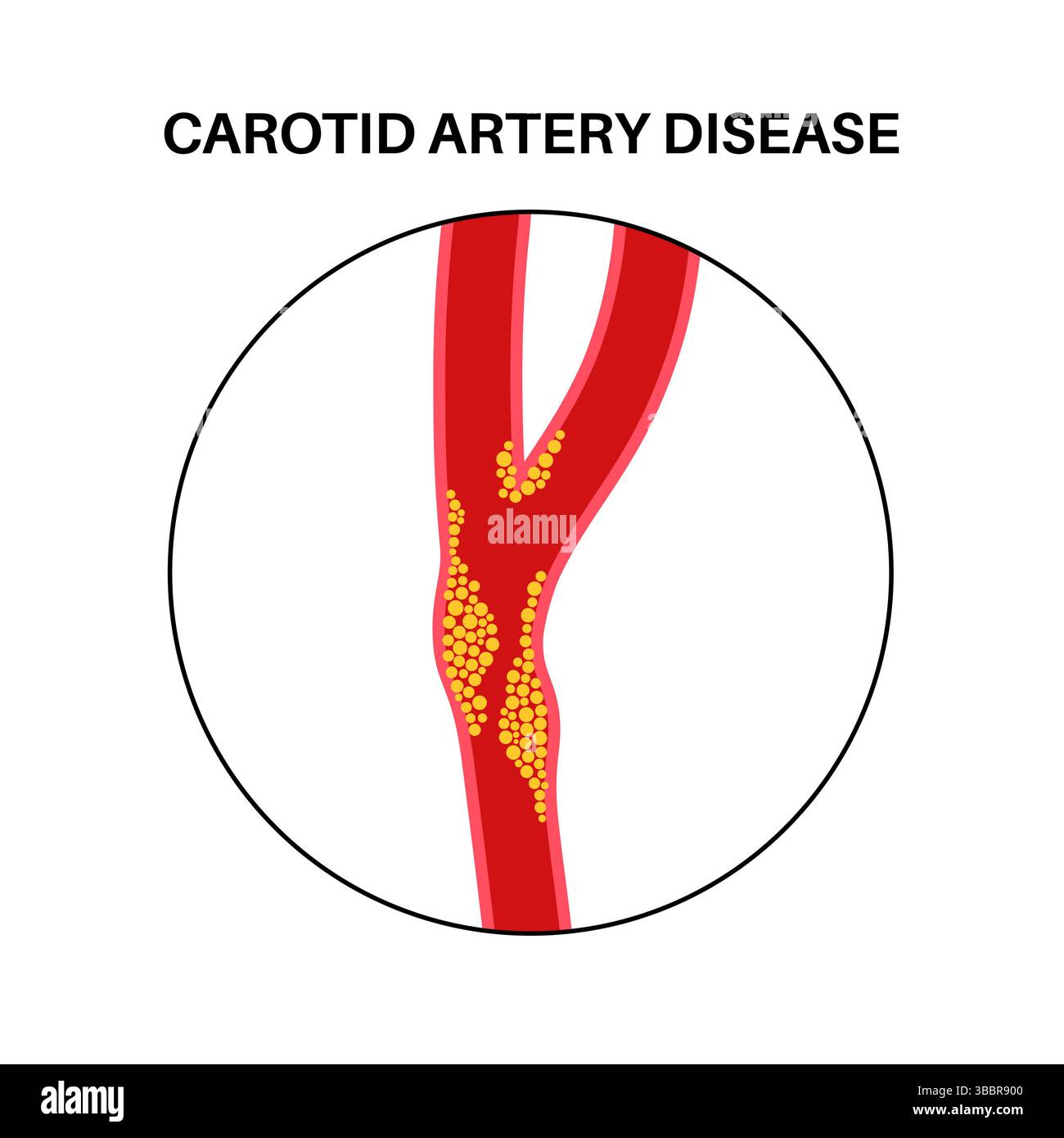Illustration of carotid artery disease. This occurs when fatty deposits ...