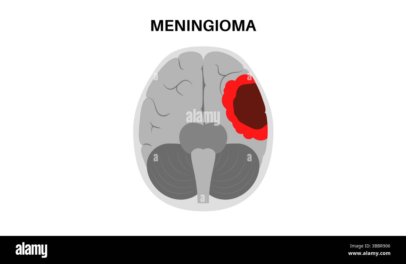 Illustration of a meningioma. This is a tumour that grows from the ...