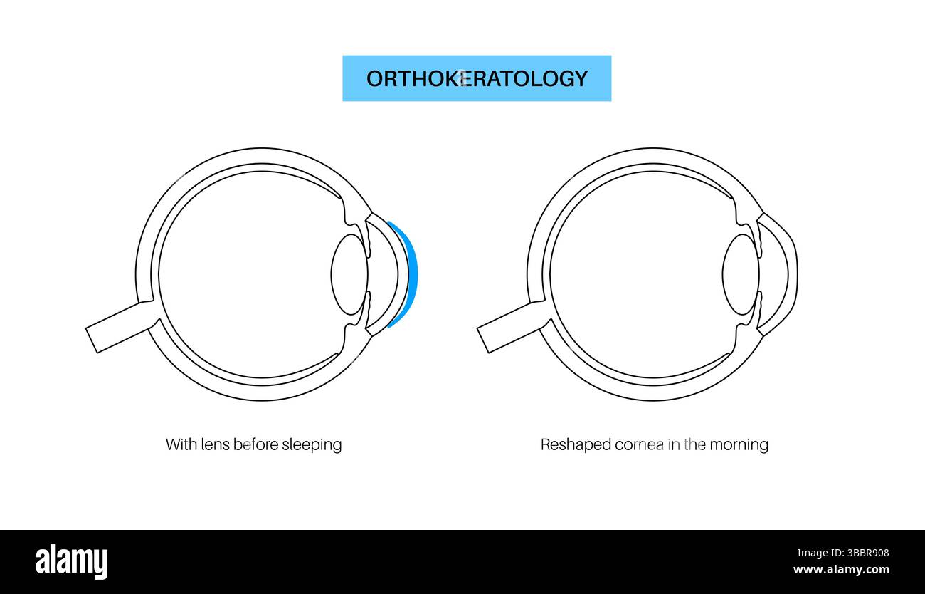 Illustration of orthokeratology fitted lens. These are specially ...