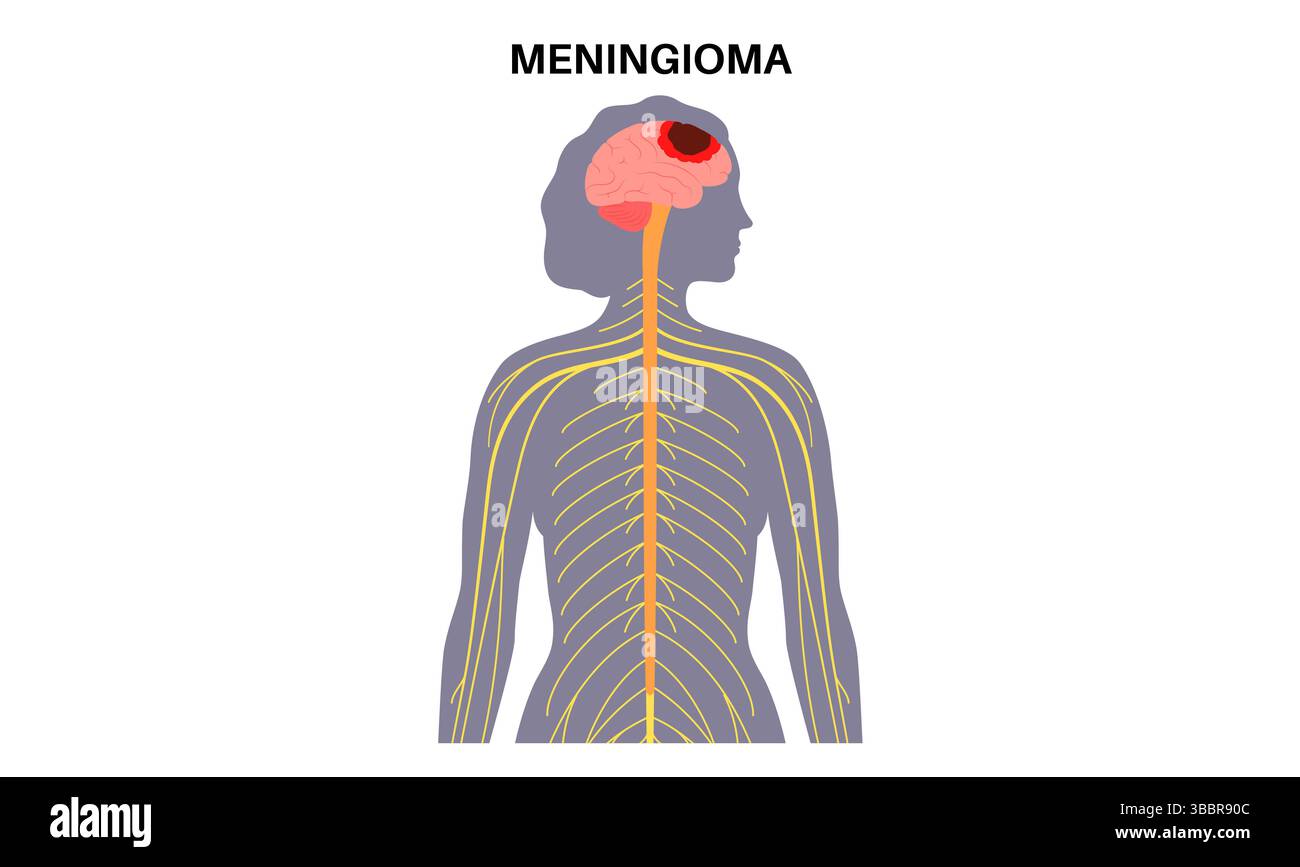 Illustration of a meningioma. This is a tumour that grows from the ...