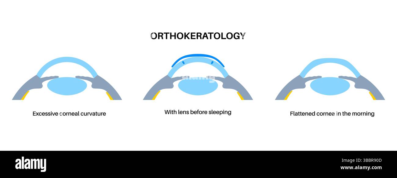 Illustration of orthokeratology fitted lens. These are specially ...