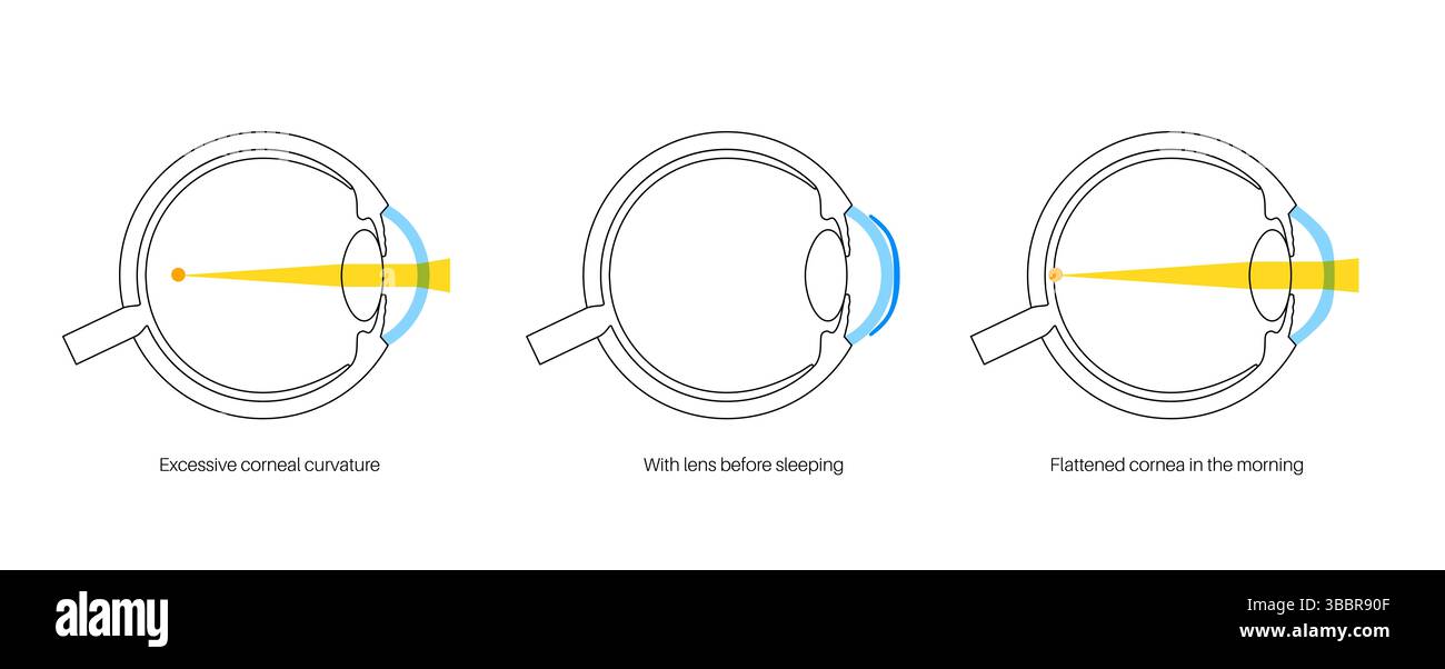 Illustration of orthokeratology fitted lens. These are specially ...