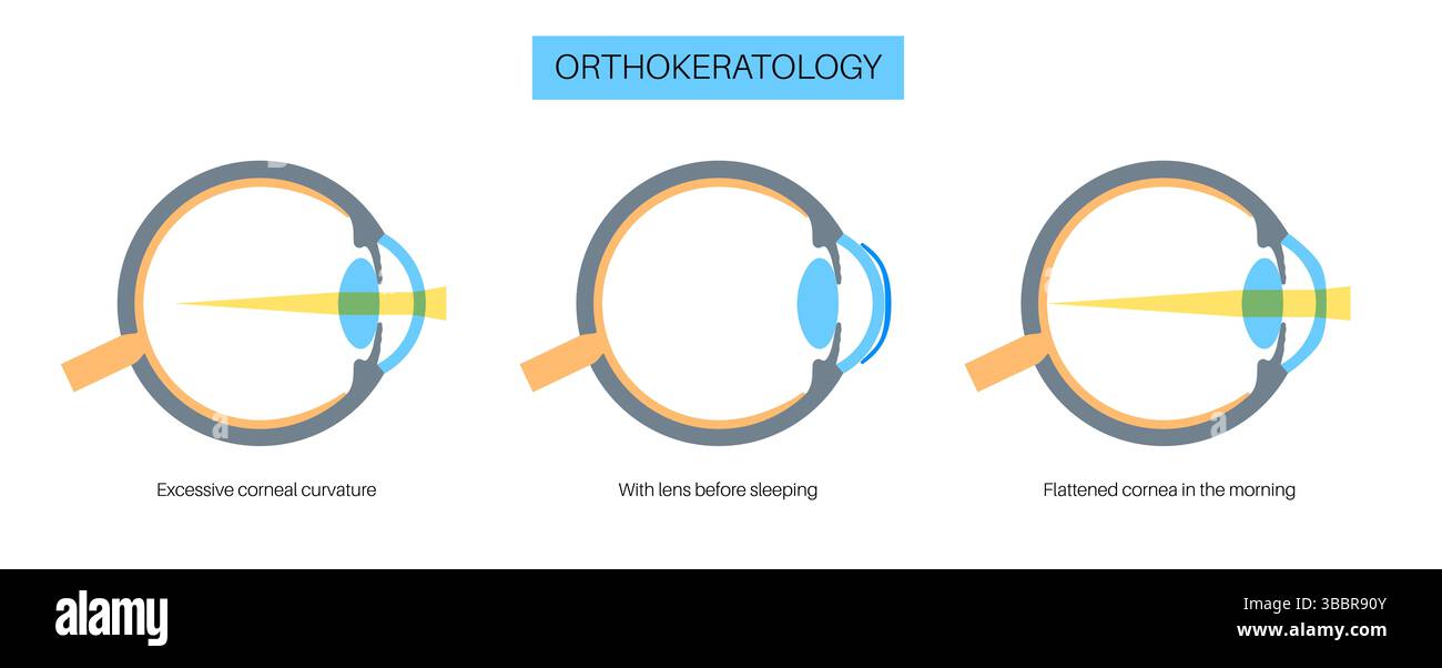 Illustration of orthokeratology fitted lens. These are specially ...