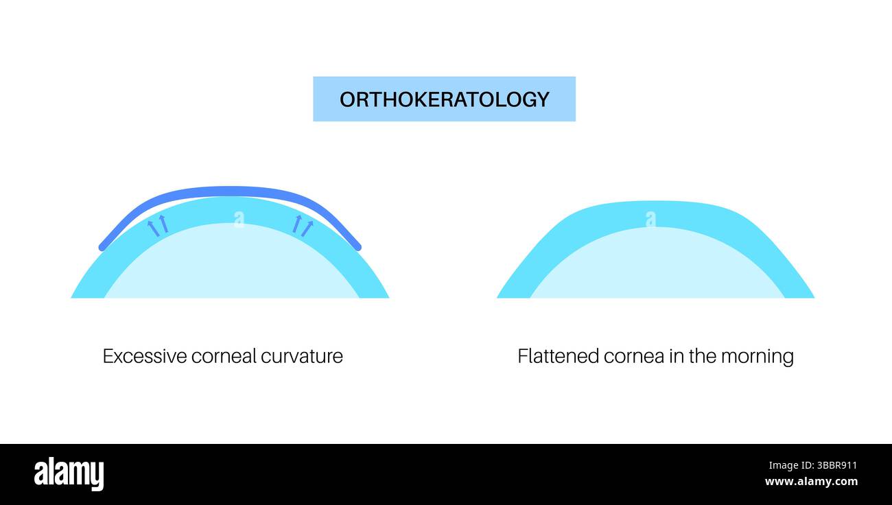 Illustration of orthokeratology fitted lens. These are specially ...