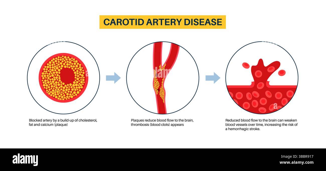 Illustration of carotid artery disease. This occurs when fatty deposits ...