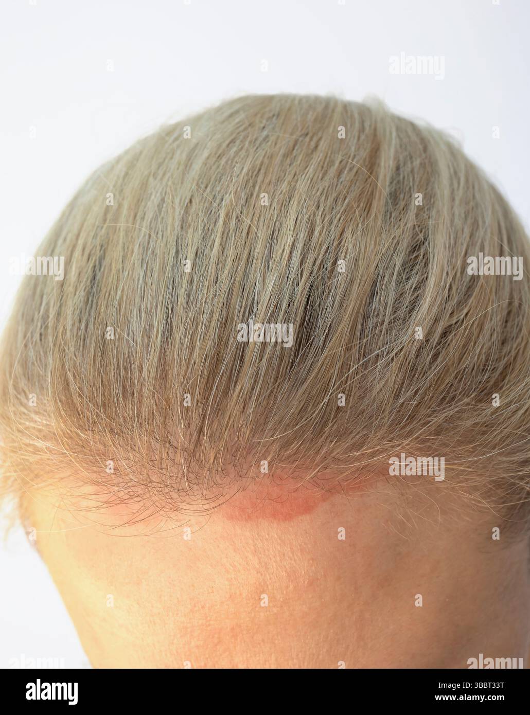 Cropped Caucasian Female Face with Sunburn Skin On Scalp, Forehead ...