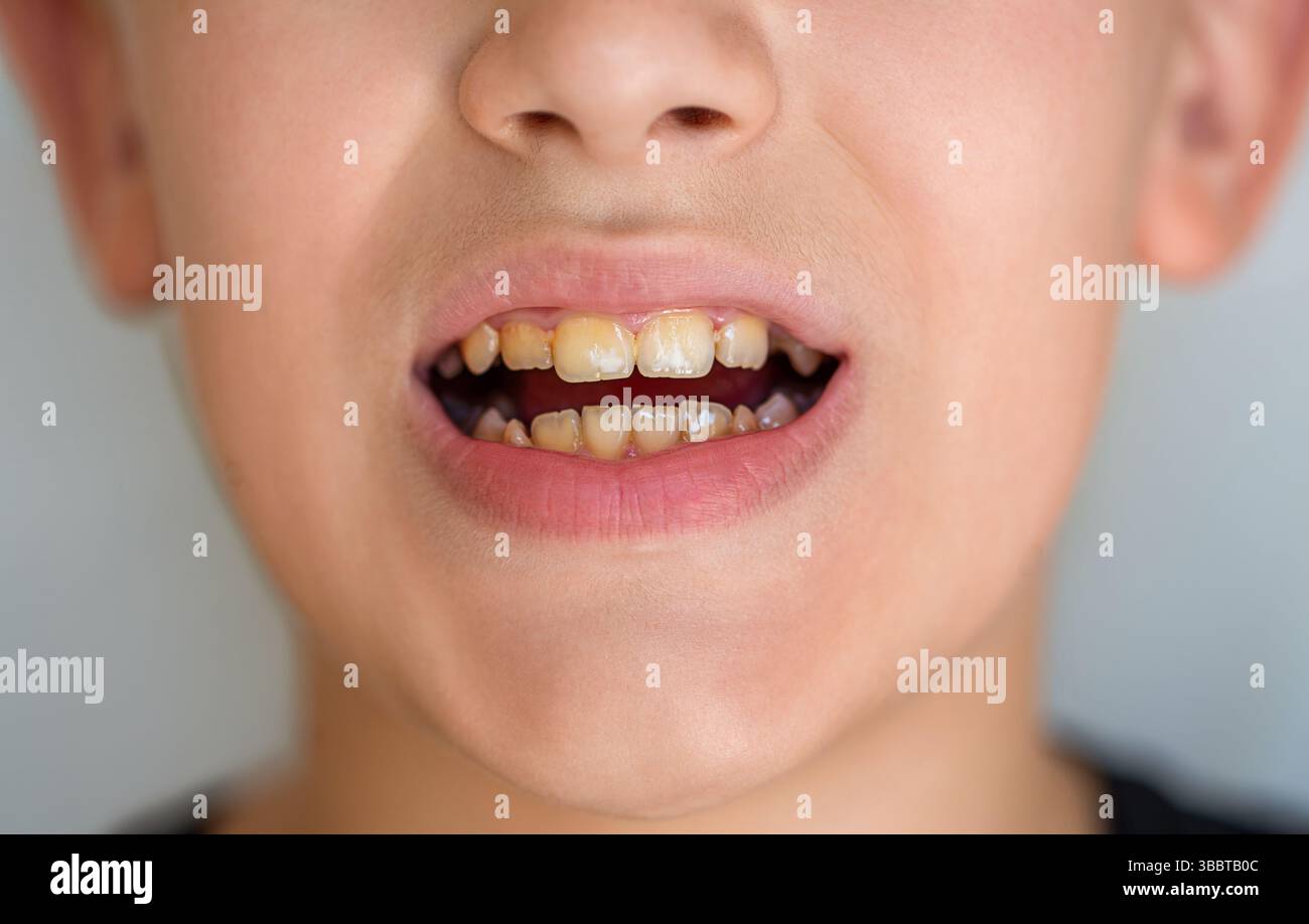 Dentistry closeup. Bad teeth child. Mouth of a man with crooked yellow ...