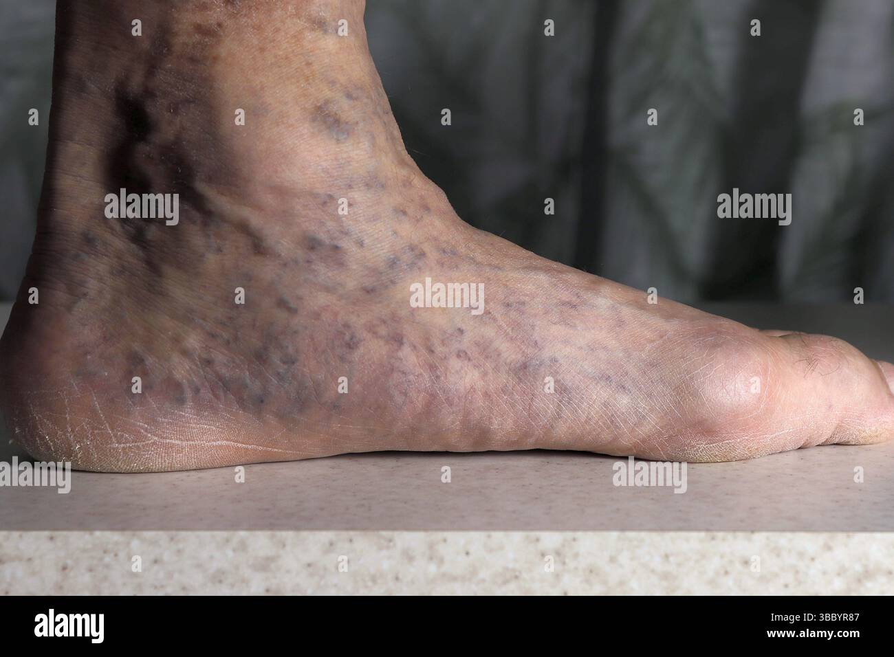 A human leg with clearly visible red spots is a consequence of varicose ...