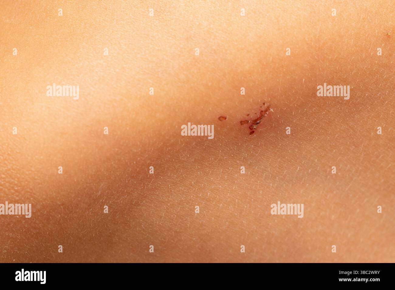 Close-up of a healing abrasion on human skin, highlighting dried blood ...