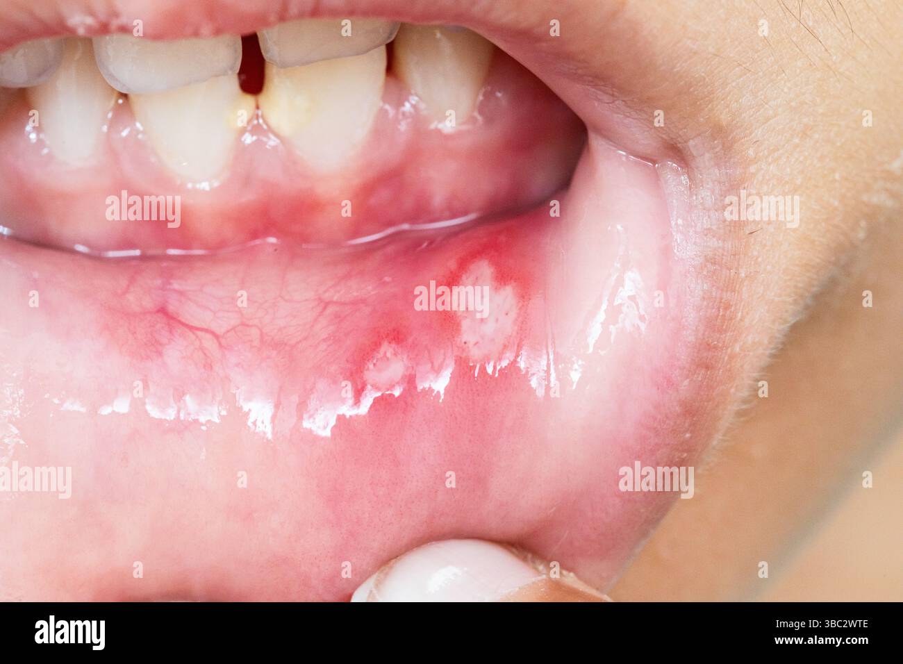 Close-up of painful aphthous stomatitis or canker sores inside a child ...